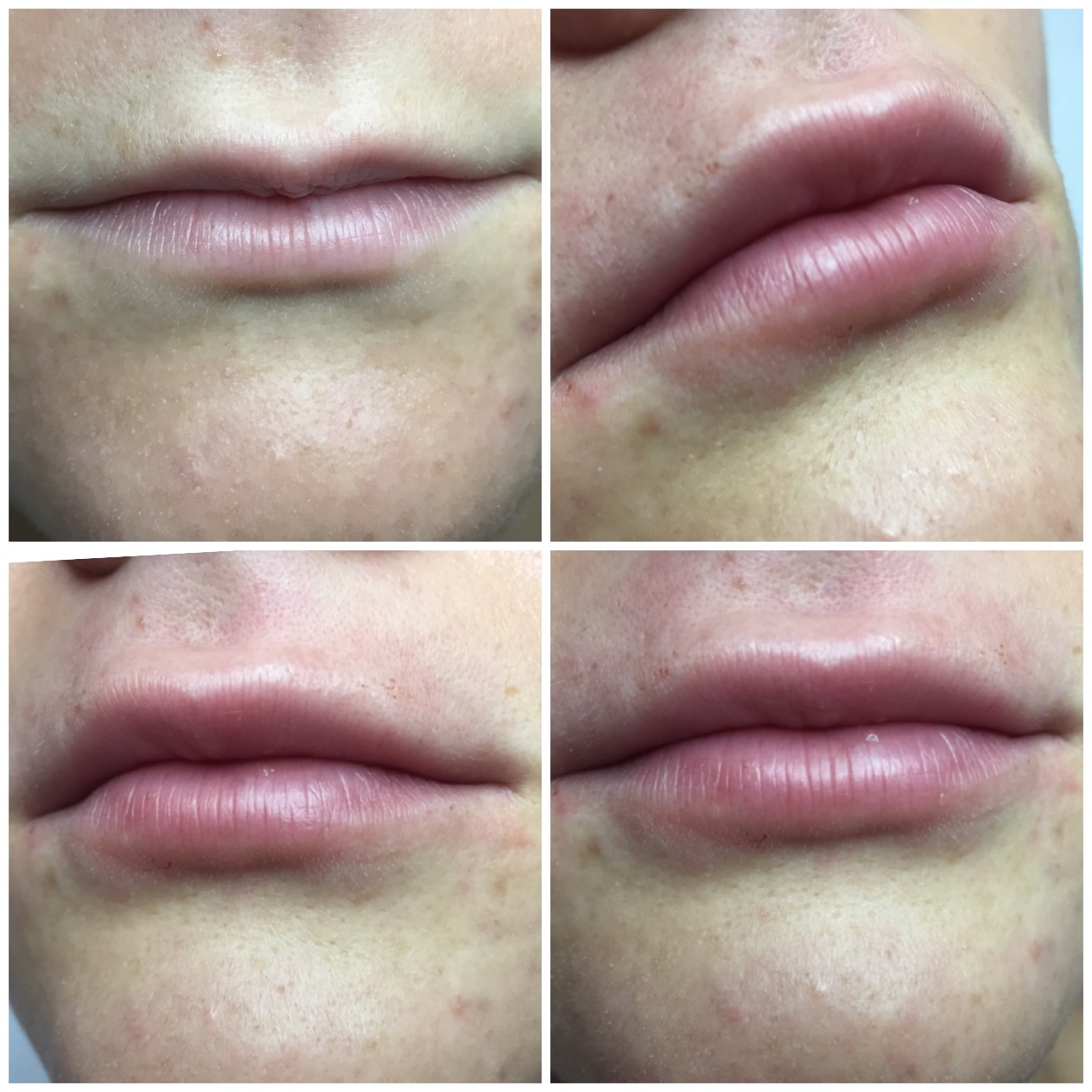 Pre i posle - Derma Estetic Centar